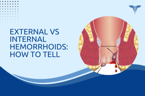 External vs Internal Hemorrhoids: How to Tell | Dr. Rajeev Premnath