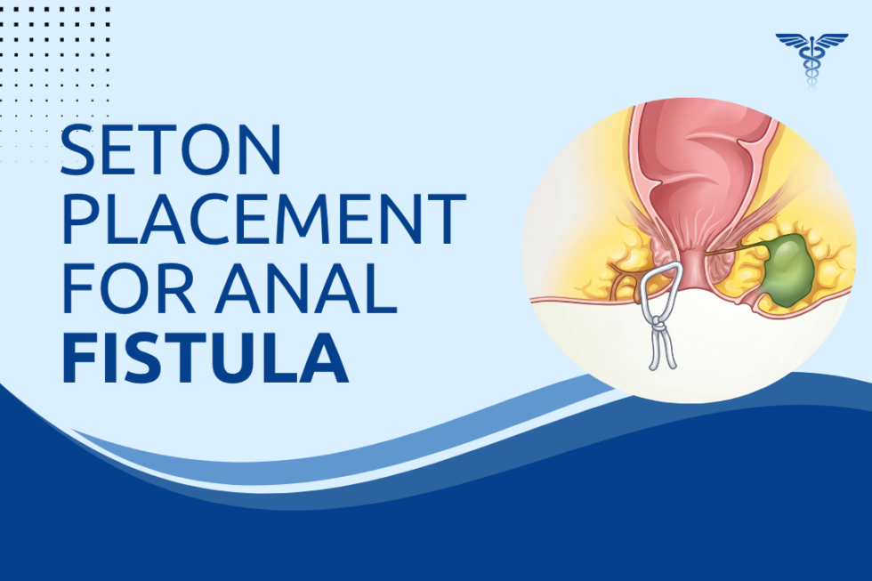 Seton Placement for Anal Fistula | Dr. Rajeev Premnath